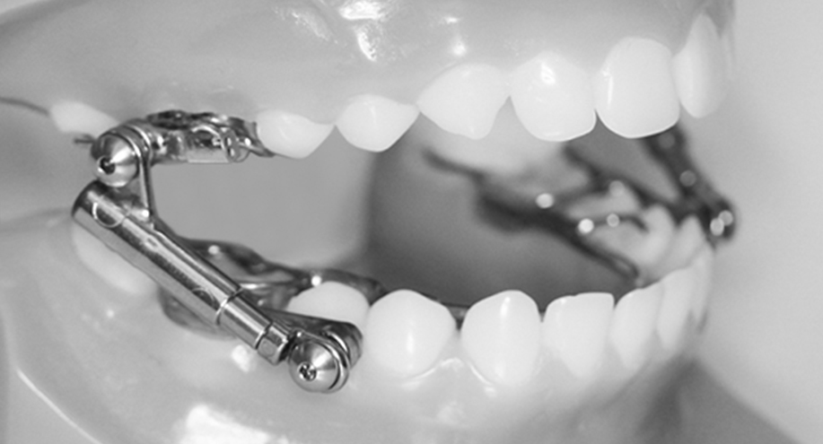 Orthodontic Appliances | Orthodontics in Coorparoo | EDGE Orthodontics